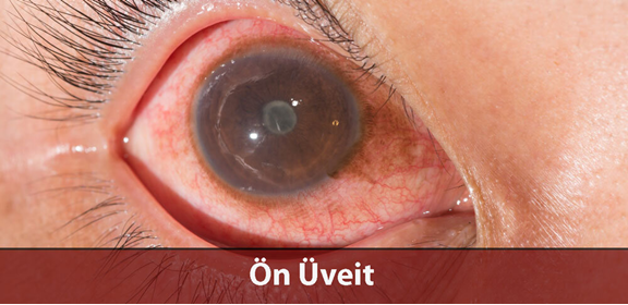 Üveit nedir? – Sakarya Kuzey
